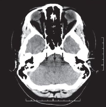 Correcting CT Scanner Artifacts: Streak Artifacts